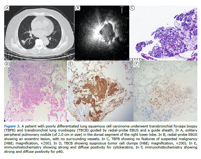 Jornal Brasileiro de Pneumologia - Diagnostic performance of cryobiopsy ...