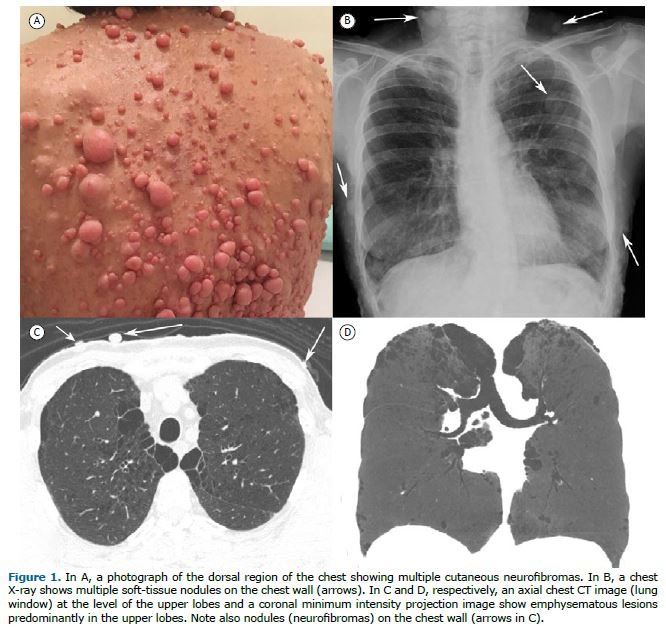 Jornal Brasileiro de Pneumologia - Pulmonary emphysema associated with ...