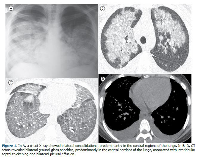 Jornal Brasileiro de Pneumologia - Transfusion-related acute lung ...