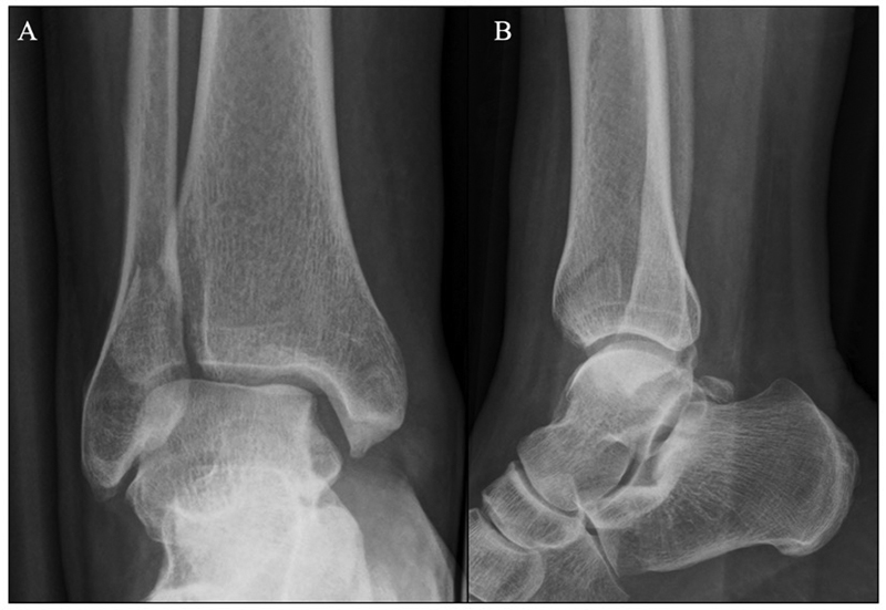 Revista Brasileira de Ortopedia - Isolated Tillaux Fracture in Adults ...