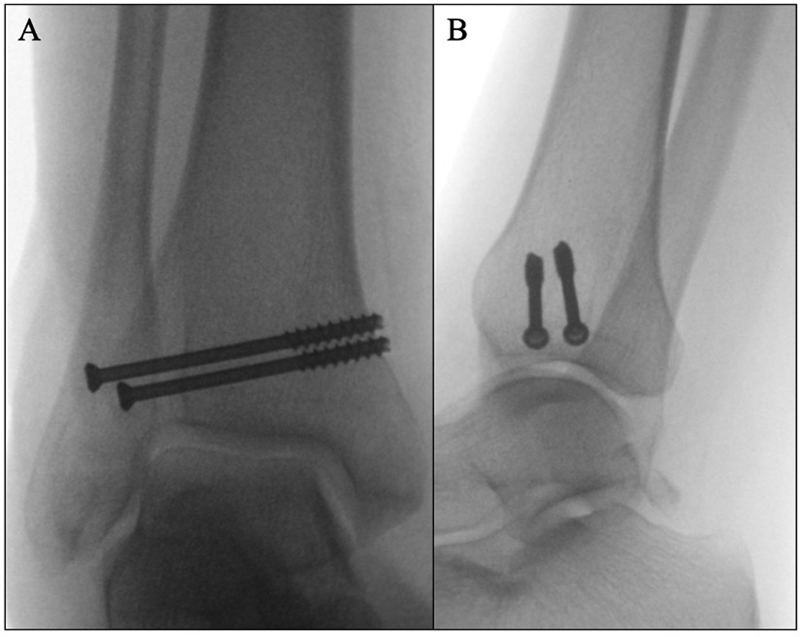 Revista Brasileira de Ortopedia - Isolated Tillaux Fracture in Adults ...