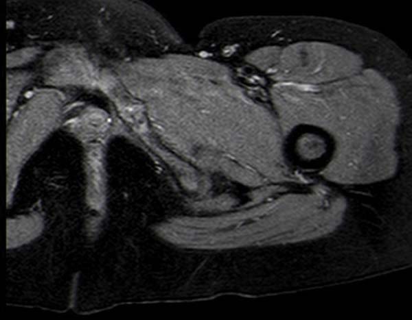 Revista Brasileira de Ortopedia - Van Neck-Odelberg Disease — A Rare or ...