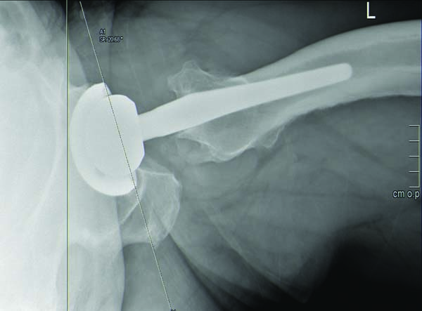 Cross Table Lateral X Ray