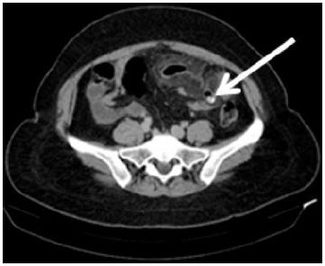 Localizacaodoapendicefeminino